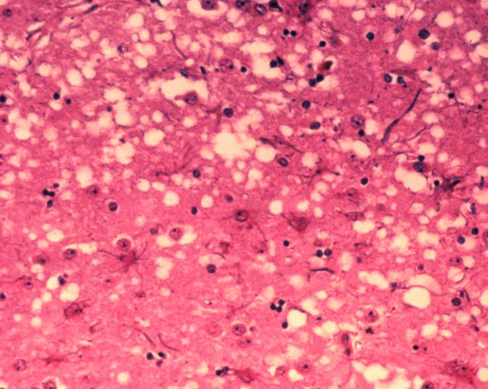 A case of Creutzfeldt-Jacob disease | Virology Blog