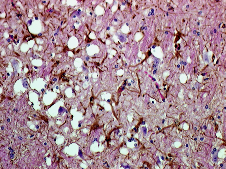 A mad cow in America | Virology Blog